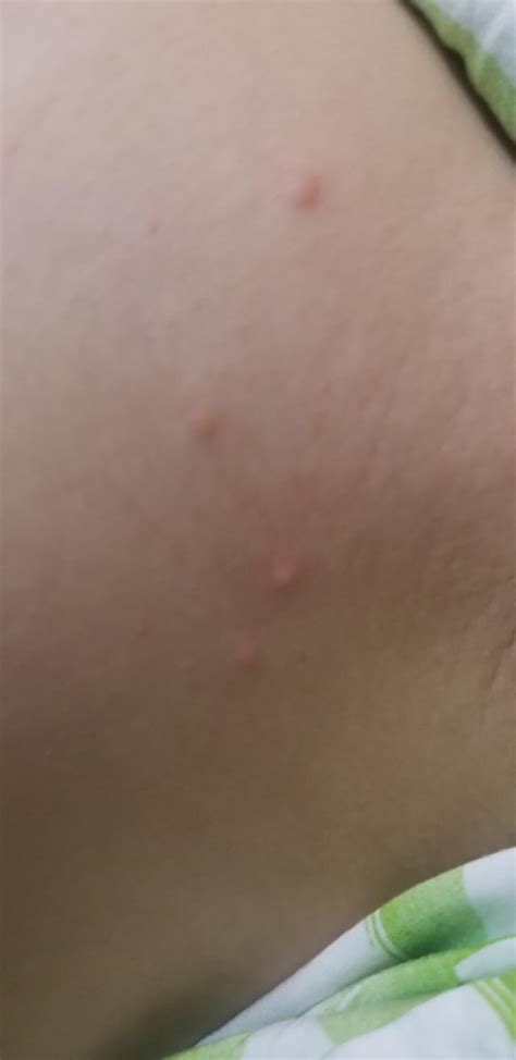 Bug Bite Identification Hue Rvietnam