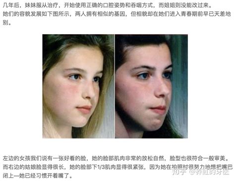认识口呼吸造成的腺样体面容 知乎