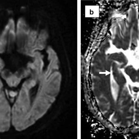 Example Of Acute Focal Diffusion Restriction In The Right Hippocampal