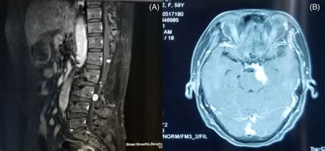 Hereditary Intraspinal Schwannomatosis With Smarcb1 Gene Mutation A