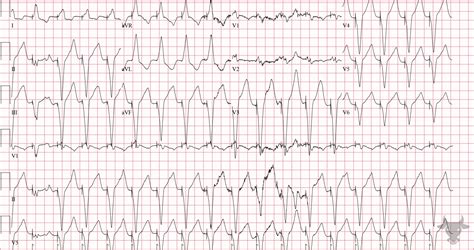 Pacemaker Malfunction Ecg Stampede
