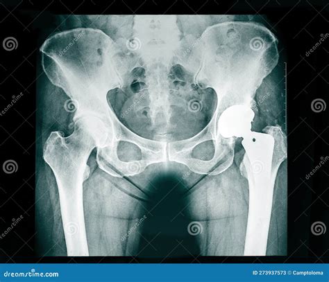 X Ray Of The Pelvis Endoprosthesis Stock Image Image Of Scan Xray