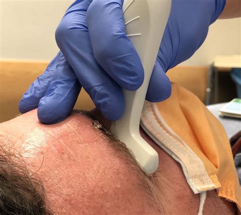 Pem Pocus Series Pediatric Ocular Ultrasound For Optic Nerve Evaluation