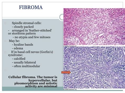 Sex Cord Stromal Tumors Pathology Pptx Reproductive Health