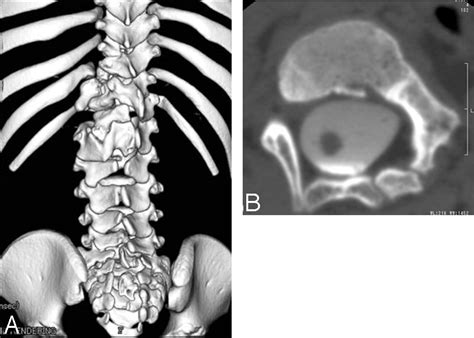 An Unusual Case Of Split Cord Malformation American Journal Of