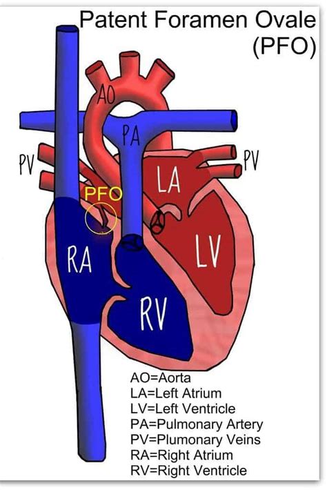 What Is The Difference Between Pda And Pfo At Jennifer Marshall Blog