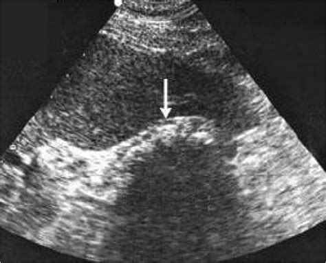 Ultrasound Shows A Constricted Gallbladder With The Possible Acoustic