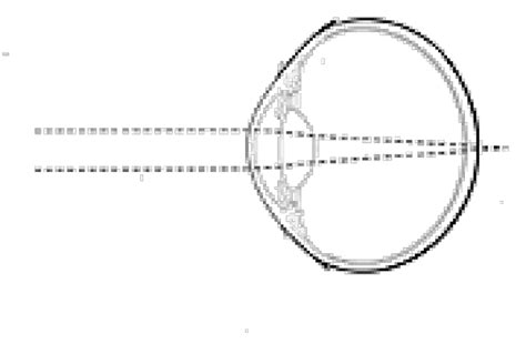 About Your Vision Stanford Eye Laser Center Stanford Medicine