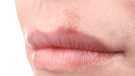 Why Is My Lip Line Swollen Lips