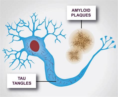 41 Overview Of Alzheimers Disease Selected Topics In Health And