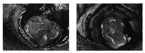 Figure 1 From Anatomical Variations Of The Hymen And Congenital