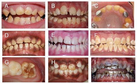 Enamel Phenotypes Encyclopedia Mdpi