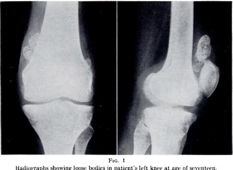 Figure 1 From A Case Of Progressive Joint Disorders Caused By