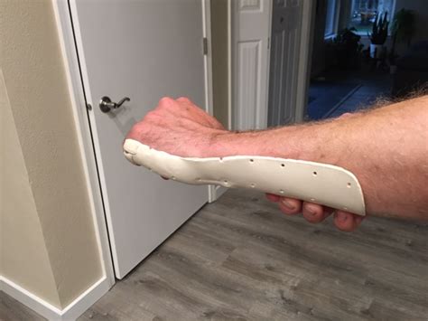 How I Healed My Subluxating Extensor Carpi Ulnaris Tendon And Homemade