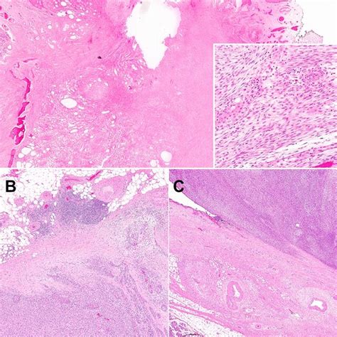 Case 1 Resection And Recurrences Metastases A Resection Showing