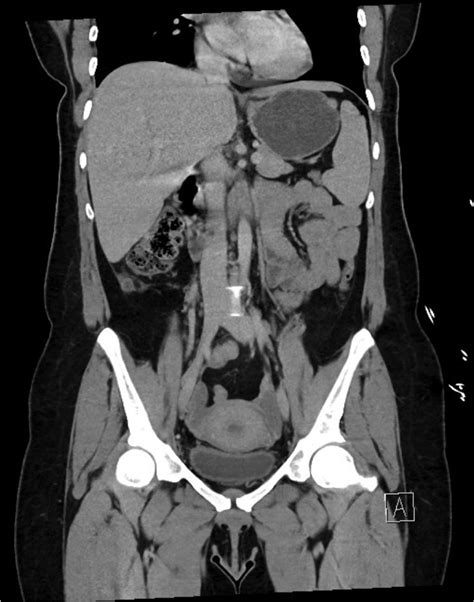Ct Pelvis Diagram Quizlet