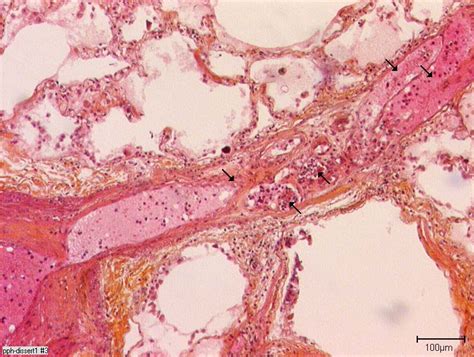 B Arterial Branch With Plexiform Lesion From Left To Right 1 Download Scientific Diagram