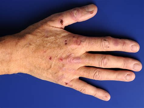 Porphyria Cutanea Tarda Milia