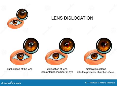 Dislocation Of The Lens Of The Eye Stock Vector Illustration Of Iris Barley 116661209