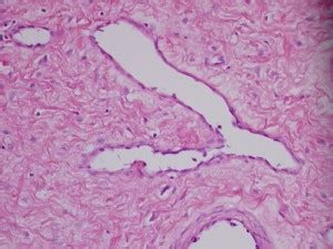 Nasopharyngeal Angiofibroma Histology