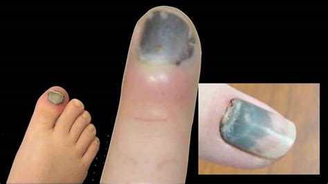 Subungual Hematoma Drainage