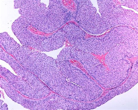 Urinary Bladder Papilloma Light Micrograph Stock Image C0382158