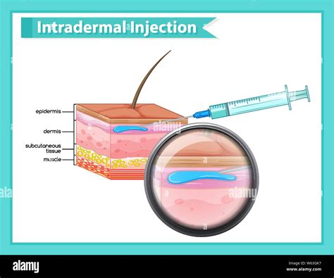 Scientific Medical Illustration Of Injection Intradermal Illustration