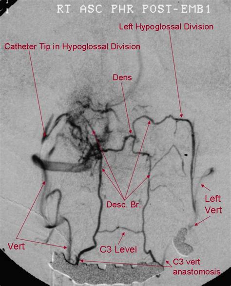 Ascending Pharyngeal Artery