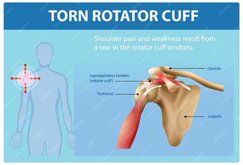 Free Vector Understanding Torn Rotator Cuff Injuries