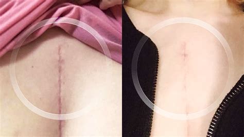 The Best Laser Scar Removal Treatment At Home Lyma