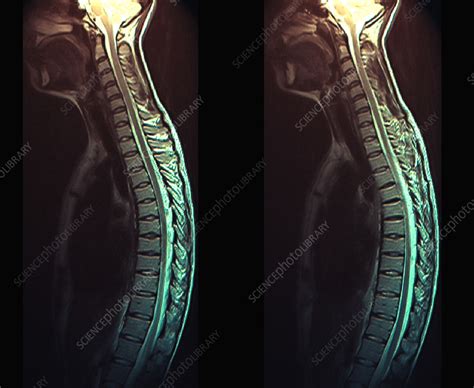 Normal Thoracic Spine Mri