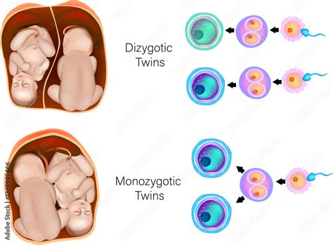 Monozygotic And Dizygotic Twins Educational Diagram Identical Vs