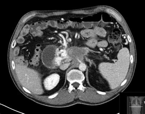 Normal Pancreas Cat Scan