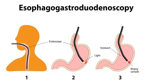 Gastroscopy Dr Farah Beshoy