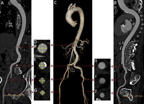 Sex Differences In Aortic Root And Vascular Anatomy In Patients