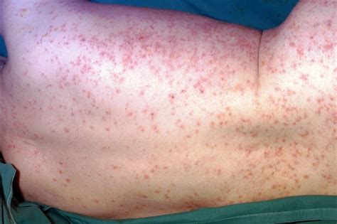 Hiv Skin