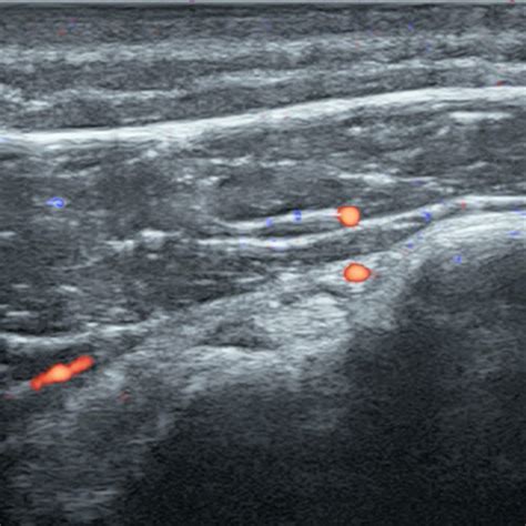 Ultrasound Training Biceps Tendon Sheath Injection Procedure