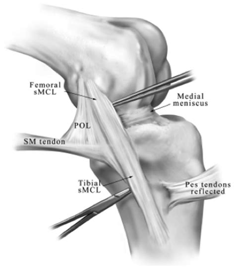 Medial And Lateral Collateral Ligament Gawpgs