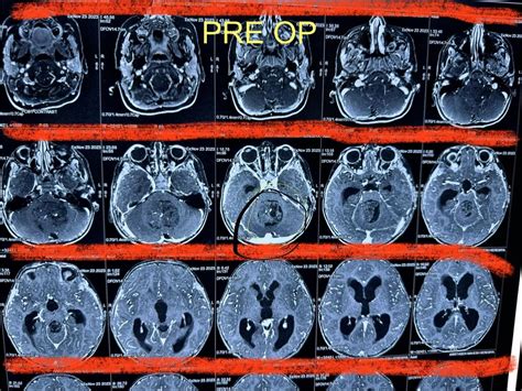 Dr Jayun Shah On Linkedin Operated This Large 4th Ventricular Sol Hp