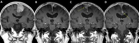 Frontiers Clinicopathologic Characteristics Of Grade 23 Meningiomas