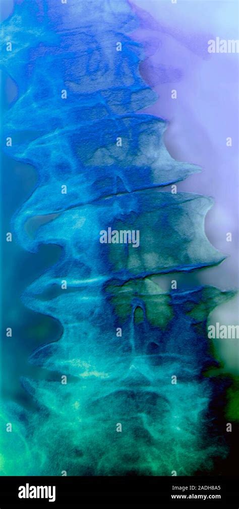 Diseased Spine Coloured X Ray Of The Dorso Lumbar Region Of The Spine