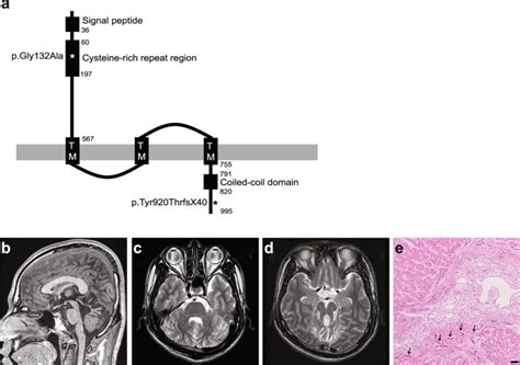 Functional Validation Of Novel Mks3tmem67 Mutations In Coach Syndrome