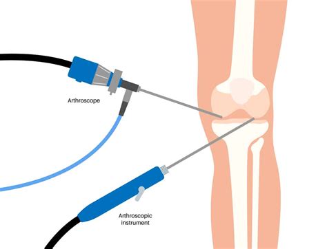 How Long Is The Recovery After Arthroscopic Knee Surgery