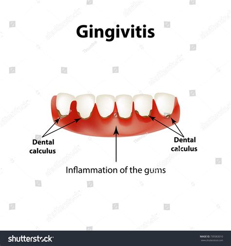 Gingivitis Inflammation Gums Dental Calculus Infographics Stock Illustration 739383010