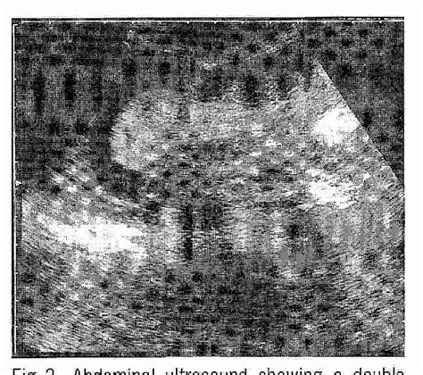 Figure 1 From A Case Of Idiopathic Intussusception In An Adult