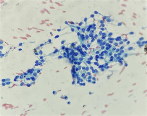Eus Gallbladder Mass Fna~90 Yo F Hx Of “skin Cancer” More Details