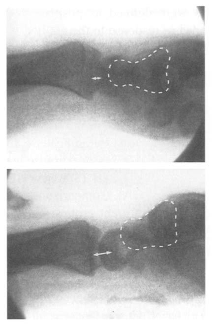 The Midcarpal Shift During The Scaphoid Shift Test The Capitate