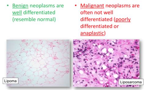 Pathology L11 Neoplasia 3 Benign Vs Malignant Invasion