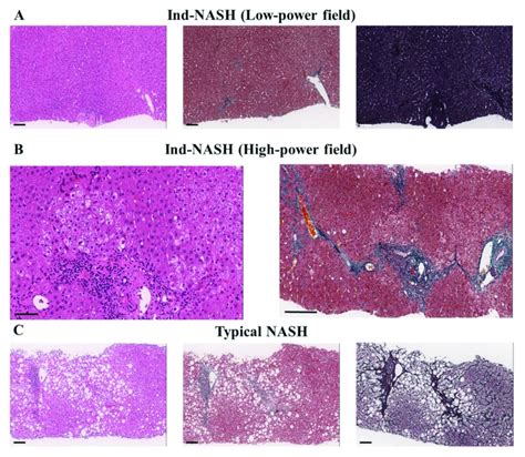 Histopathological Differences Between Ind Nash And Typical Nash
