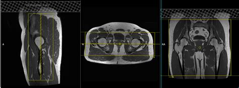 Mri Arthrogram Hip Protocol And Planning Indications For Mri